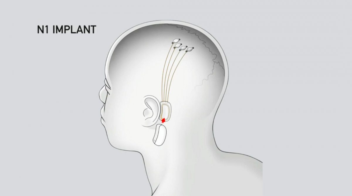 สรุป Neuralink: แผนของ อีลอน มัสก์ ที่จะทำให้คนกับคอมพิวเตอร์อยู่ร่วมกัน