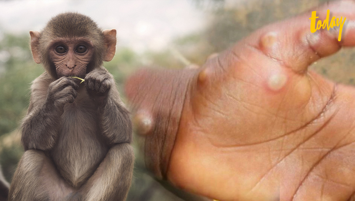 องค์กรวิชาชีพทางการแพทย์ร่วมกันลงนามประกาศ 9 ข้อ ‘โรคฝีดาษลิง’